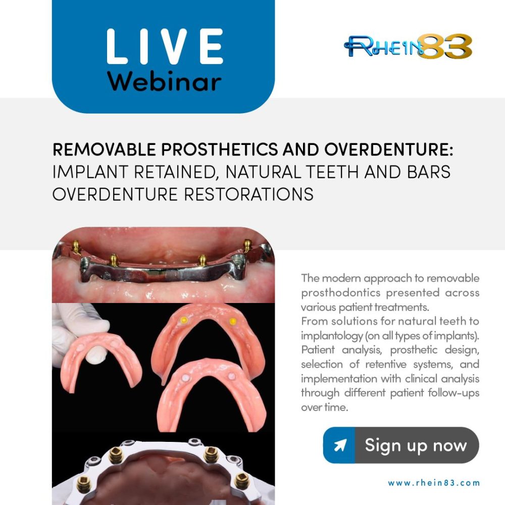Rhein83 Webinar Series #1 : Implant Retained, Natural Teeth & Bars ...